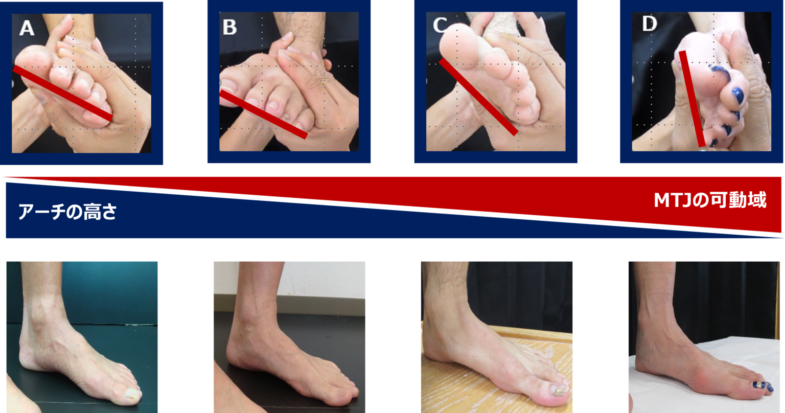 さまざまなトラブルの原因となるオーバープロネーション（過剰回内） - ashinavi