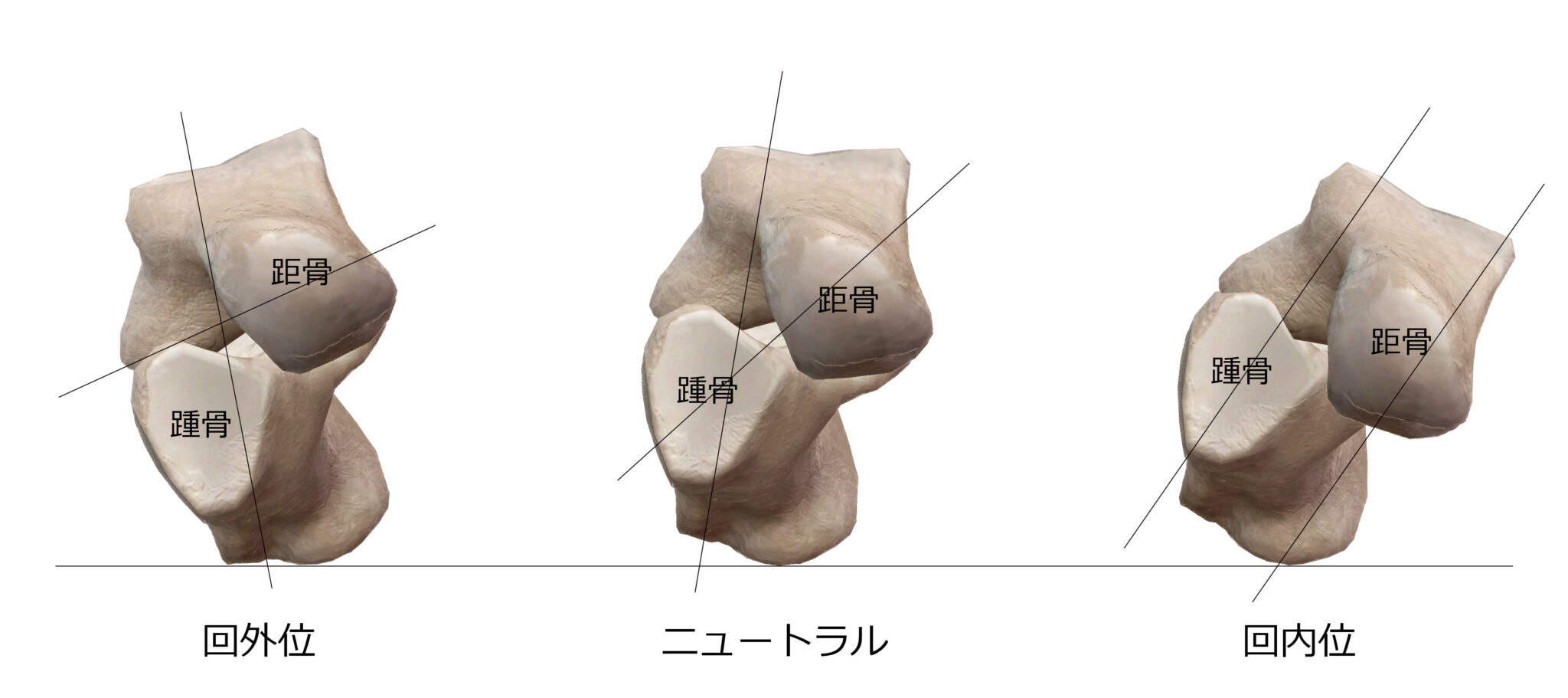 オーバープロネーション（過剰回内）大全（β版）(2023年1月24日更新） - ashinavi